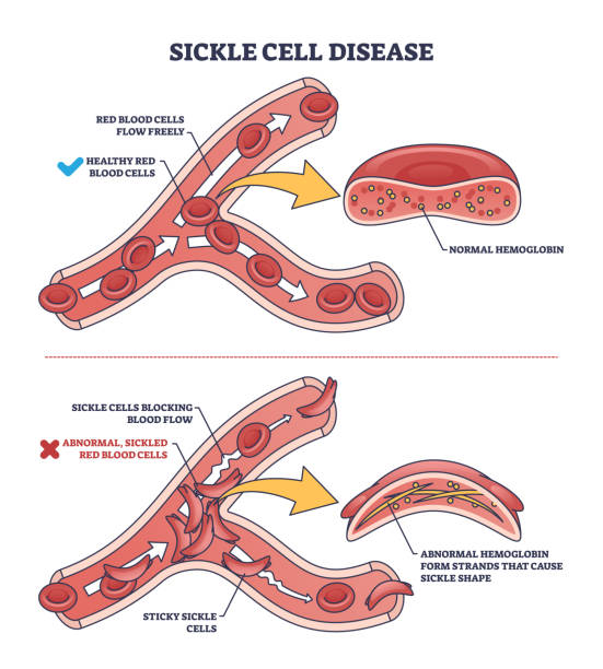 Sickle Cell Disease Awareness